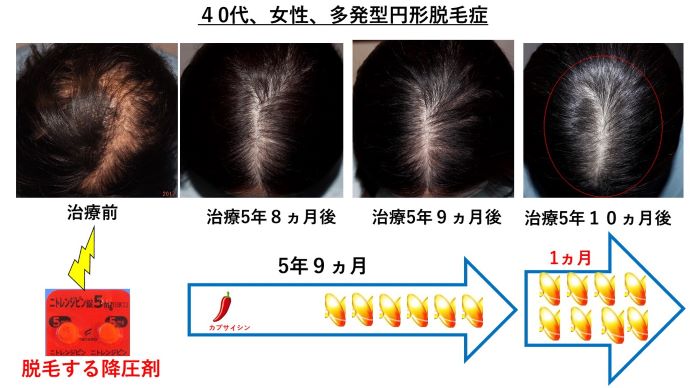 脱毛する降圧剤で発症した円形脱毛症の患者さん、カプサイシン1日8錠で難治部分改善！ 患者様からの声・メディア掲載・クリニックからのお知らせ